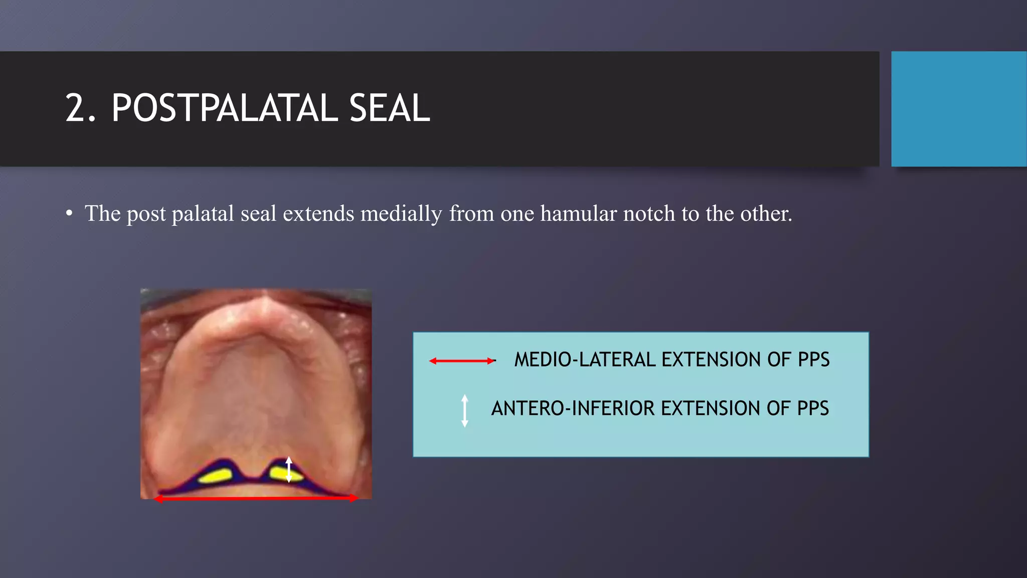 Posterior Palatal Seal Area | PPTX