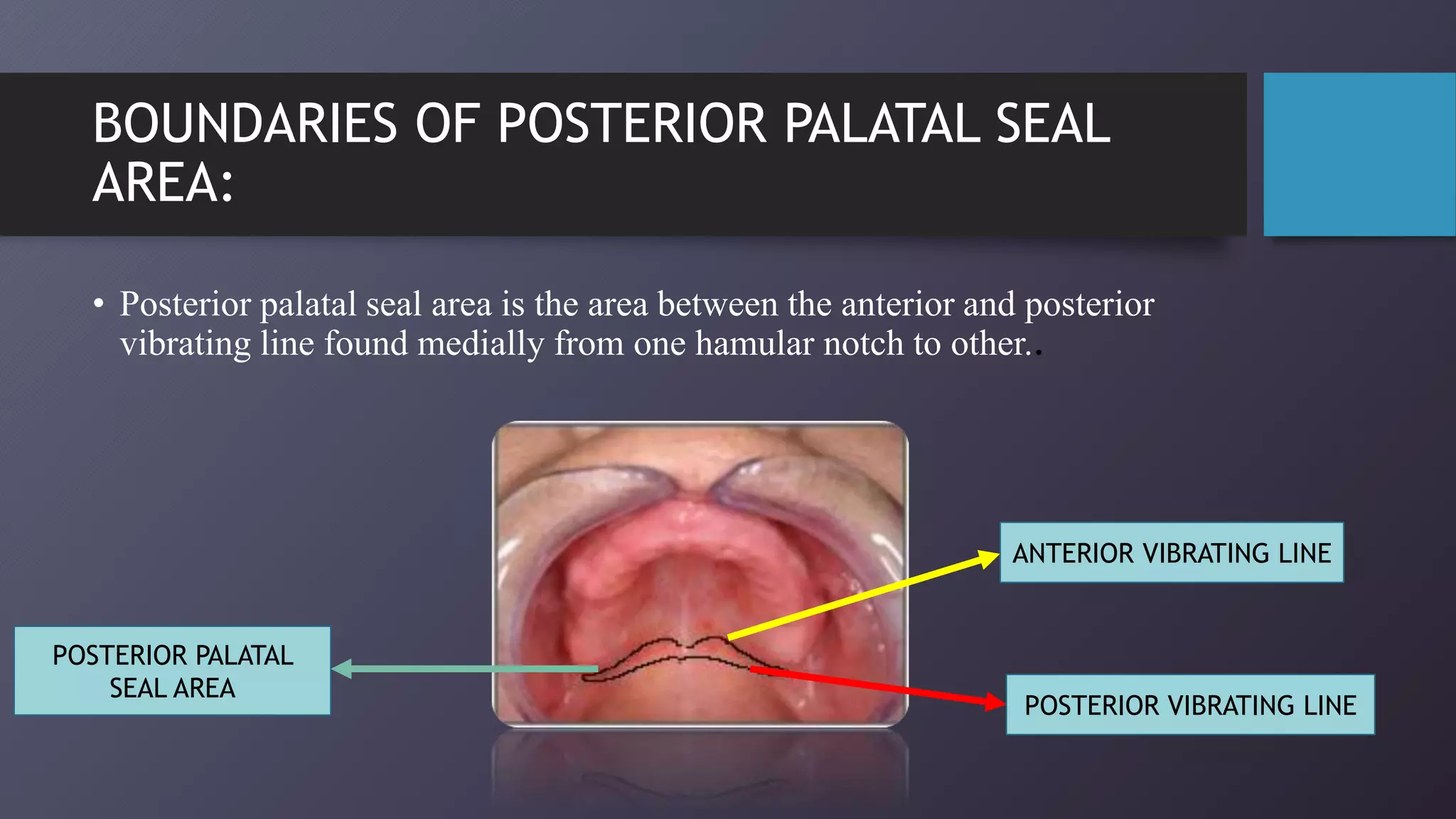 Posterior Palatal Seal Area | PPTX