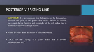 Vibrating Line