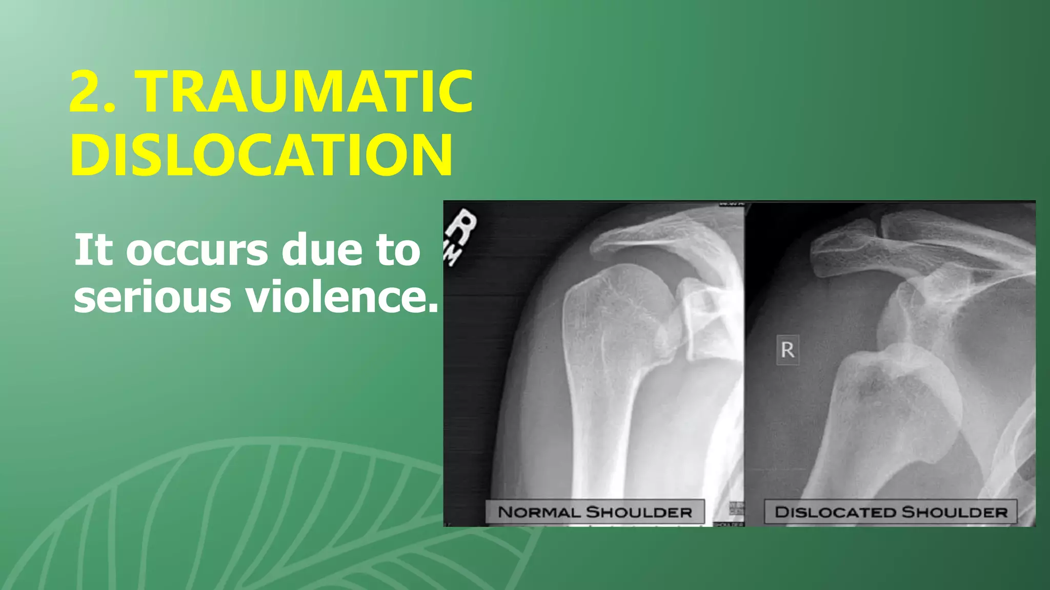 Dislocation,sprain,strain and contusion.pptx