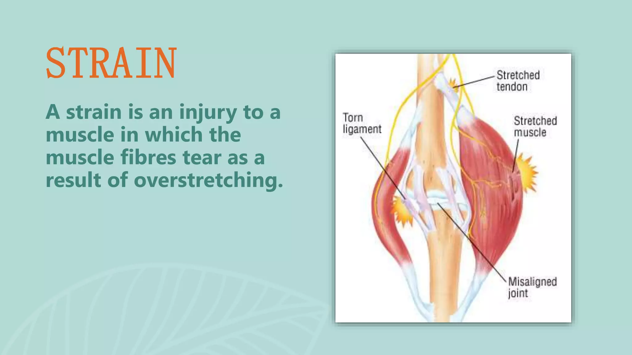 Dislocation,sprain,strain and contusion.pptx