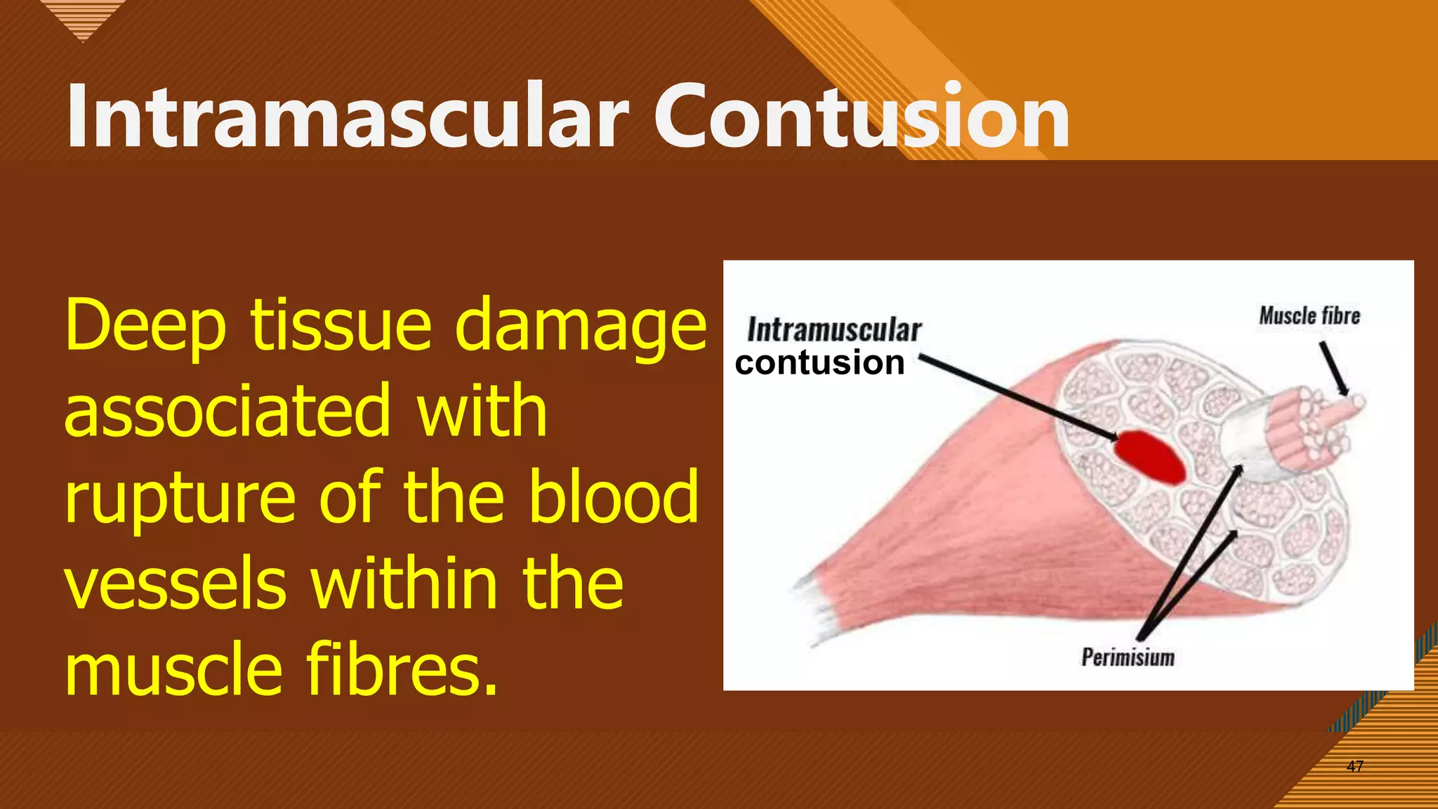 Dislocation,sprain,strain and contusion.pptx