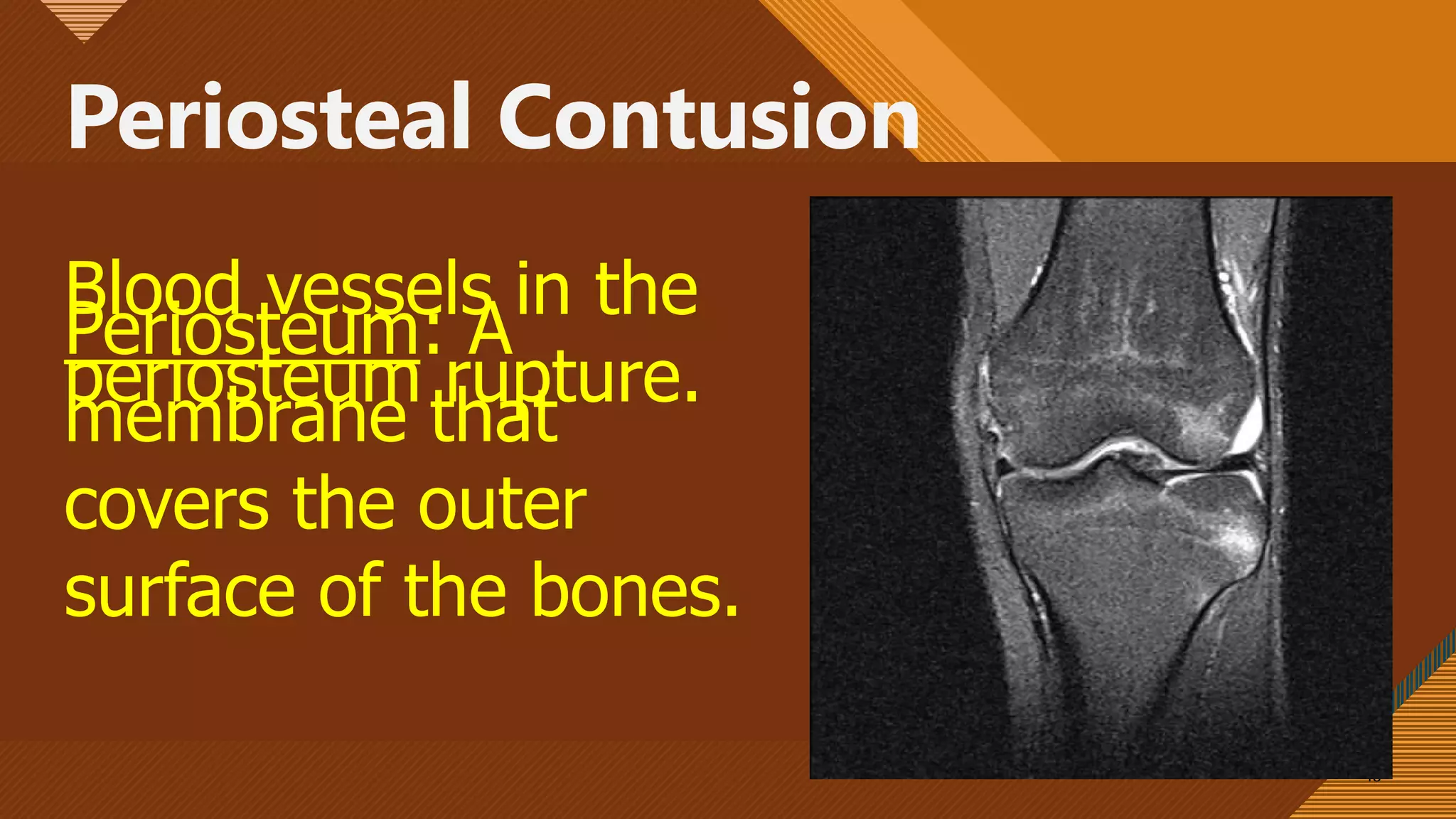 Dislocation,sprain,strain and contusion.pptx
