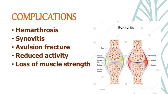 Dislocation,sprain,strain and contusion.pptx