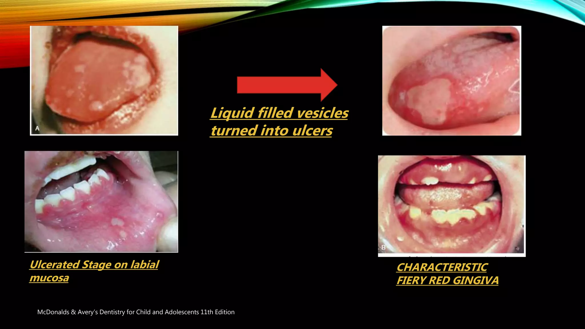 Viral, Bacterial And Fungal Infections In children | PPTX