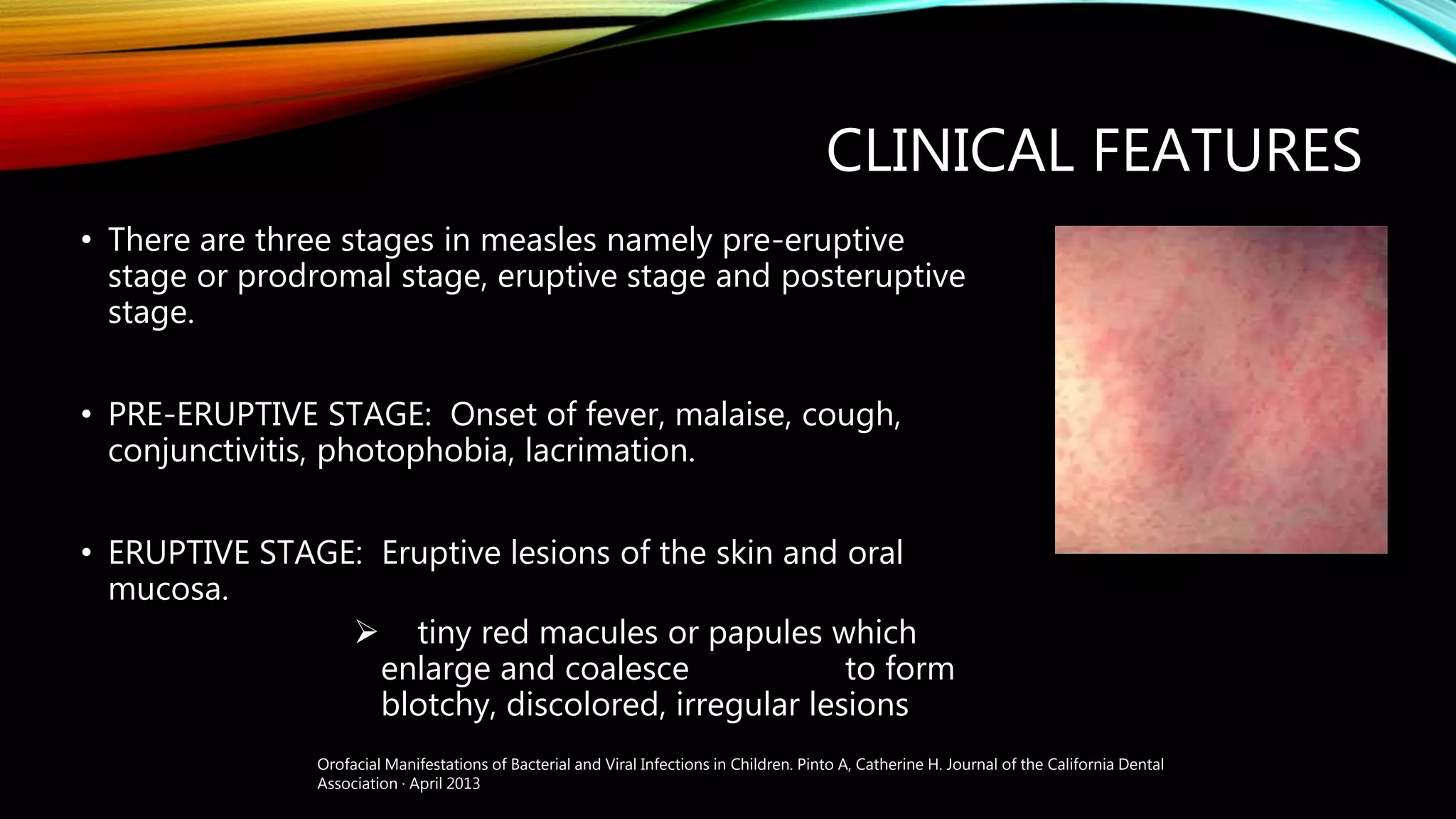 Viral, Bacterial And Fungal Infections In children | PPTX