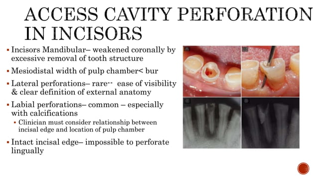 Perforation in Endodontics | PPTX