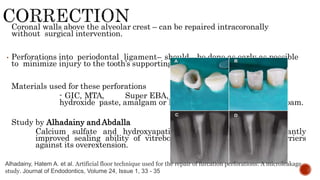 Perforation in Endodontics | PPTX
