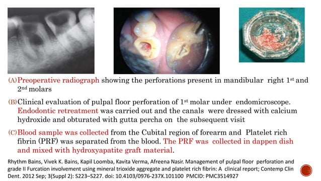 Perforation in Endodontics | PPTX