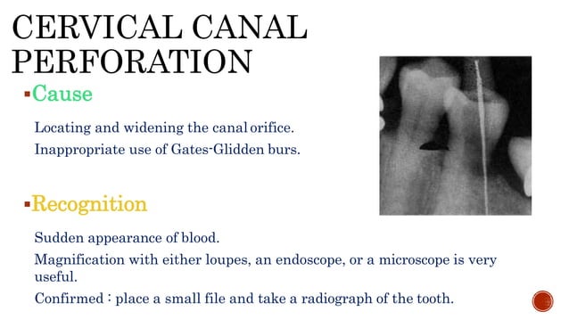 Perforation in Endodontics | PPTX