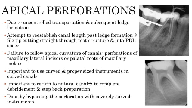 Perforation in Endodontics | PPTX