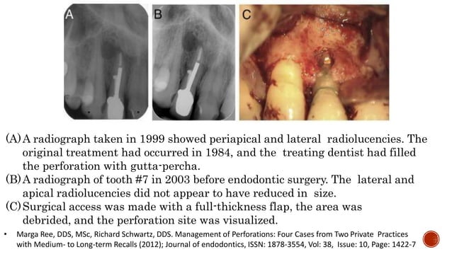 Perforation in Endodontics | PPTX