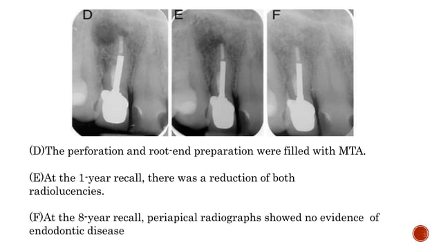 Perforation in Endodontics | PPTX