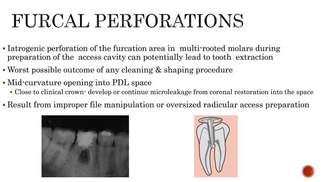Perforation in Endodontics