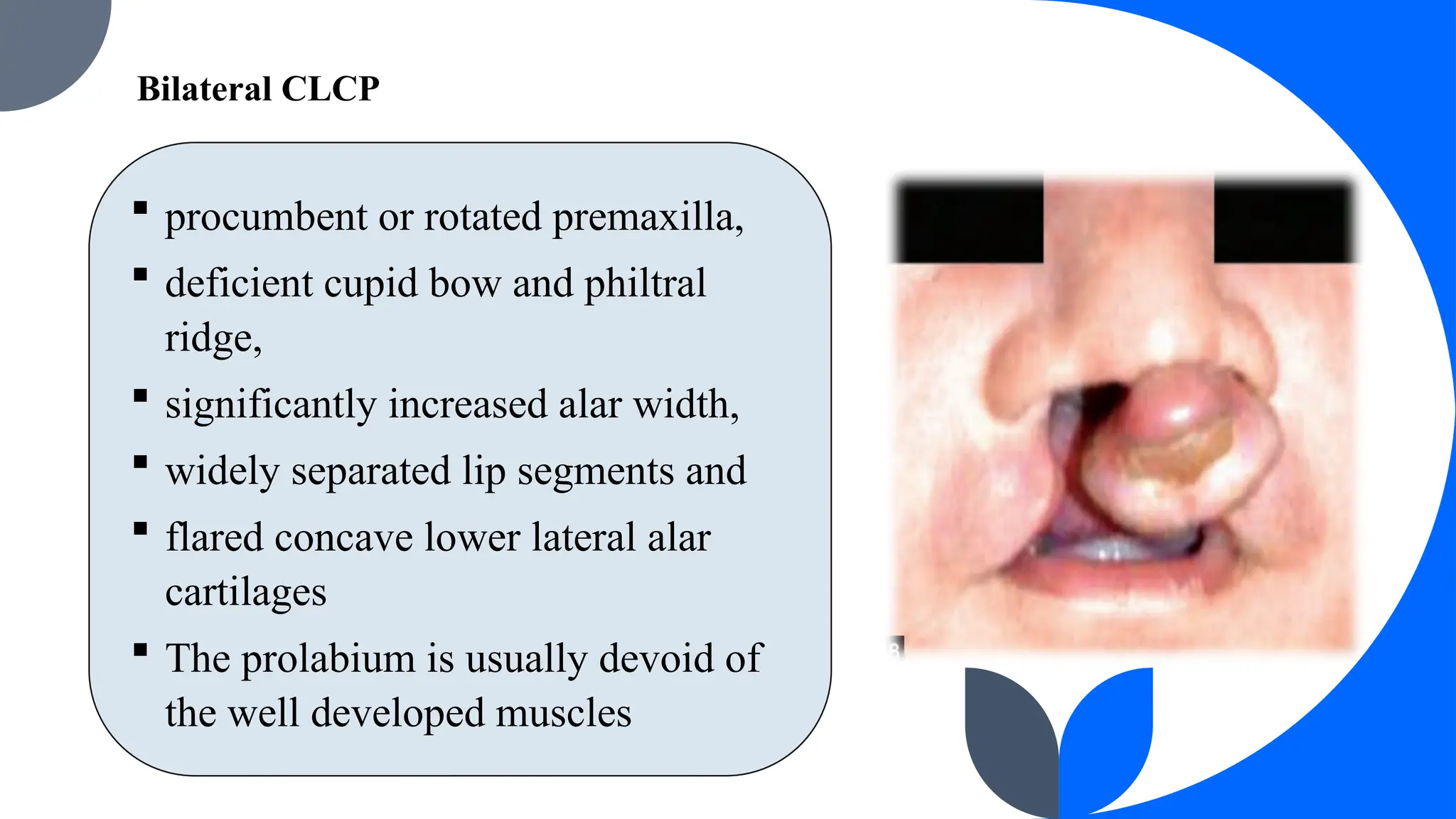Presurgical Nasoalveolar Molding in infants | PPTX