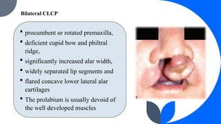 Presurgical Nasoalveolar Molding in infants | PPT