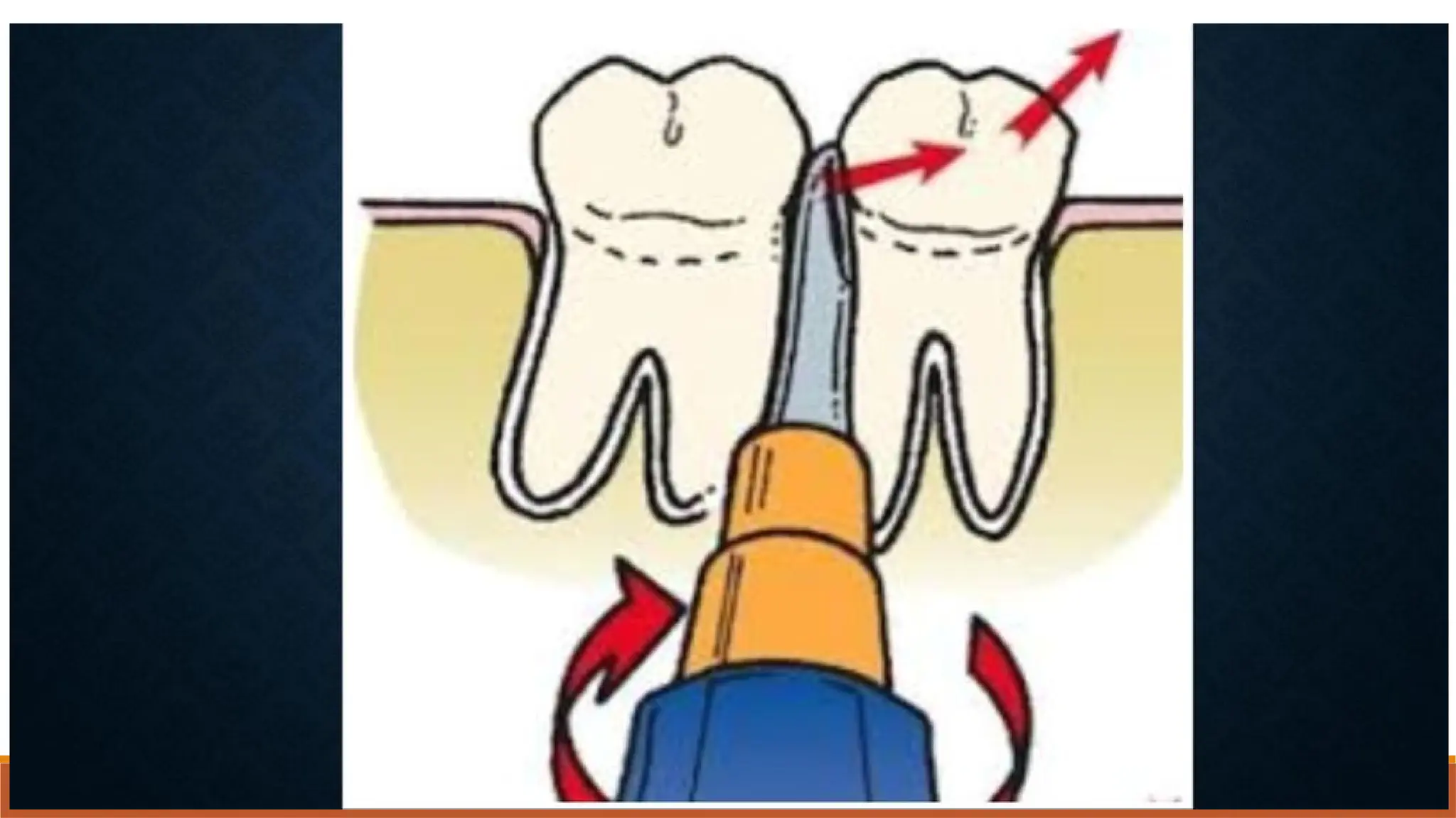 Seminar 4 Elevators used in oral & maxillofacial surgery | PPT