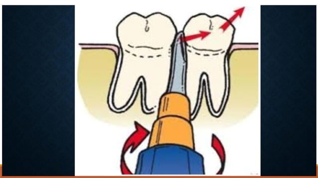 Seminar 4 Elevators used in oral & maxillofacial surgery | PPT