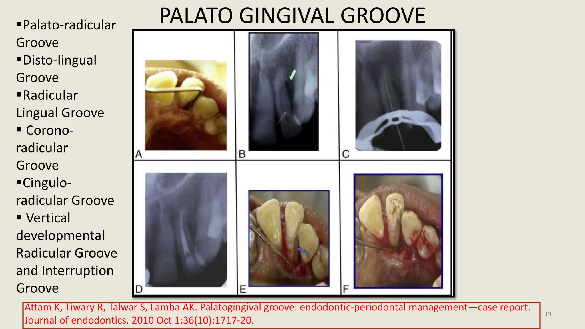 INTERNAL ANATOMY OF PERMANENT TOOTH - Endodontic approaches. | PPTX