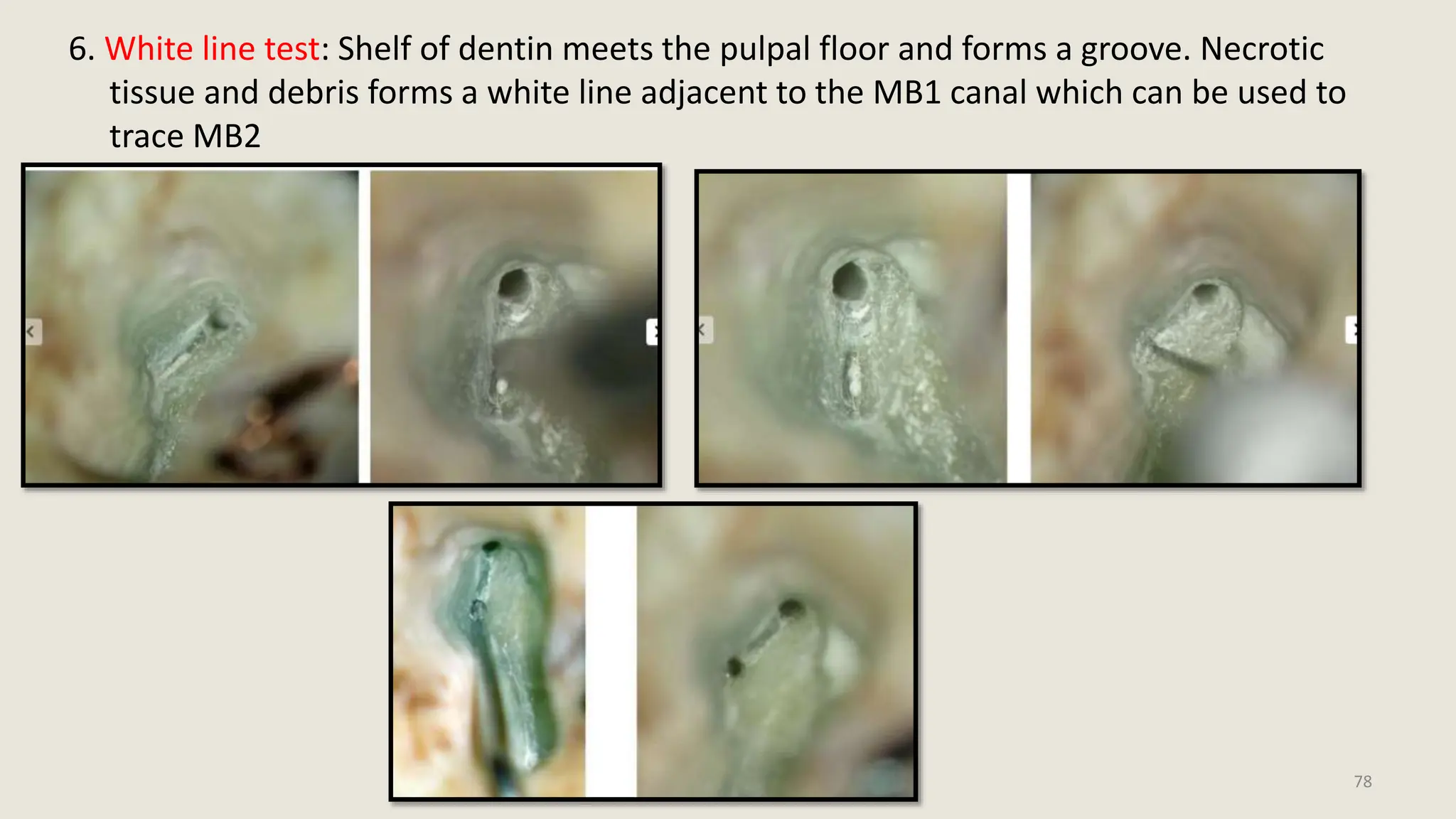 INTERNAL ANATOMY OF PERMANENT TOOTH - Endodontic approaches. | PPTX