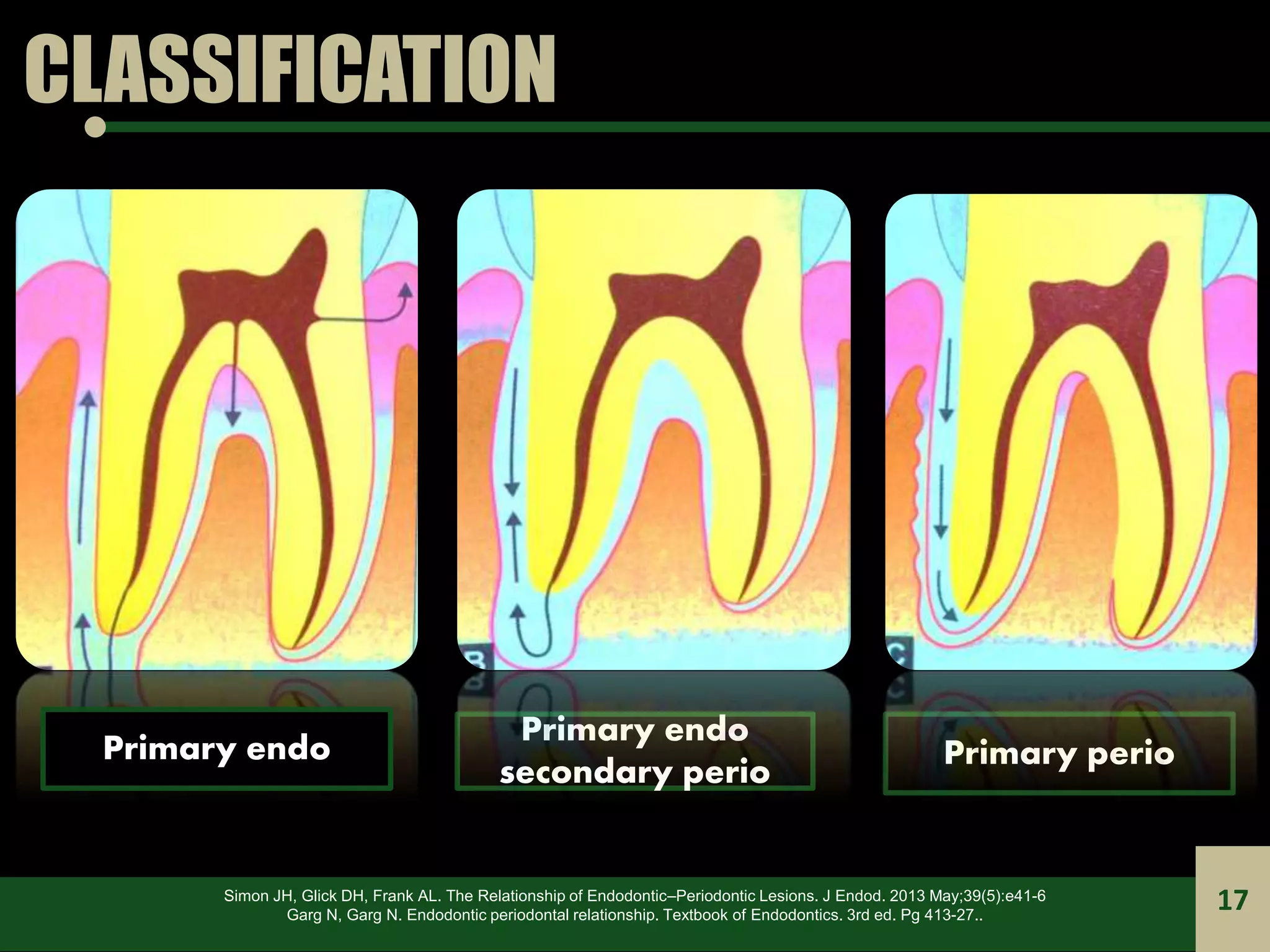 Endodontic Periodontal Relationship, ENDO PERIO LESION | PPTX