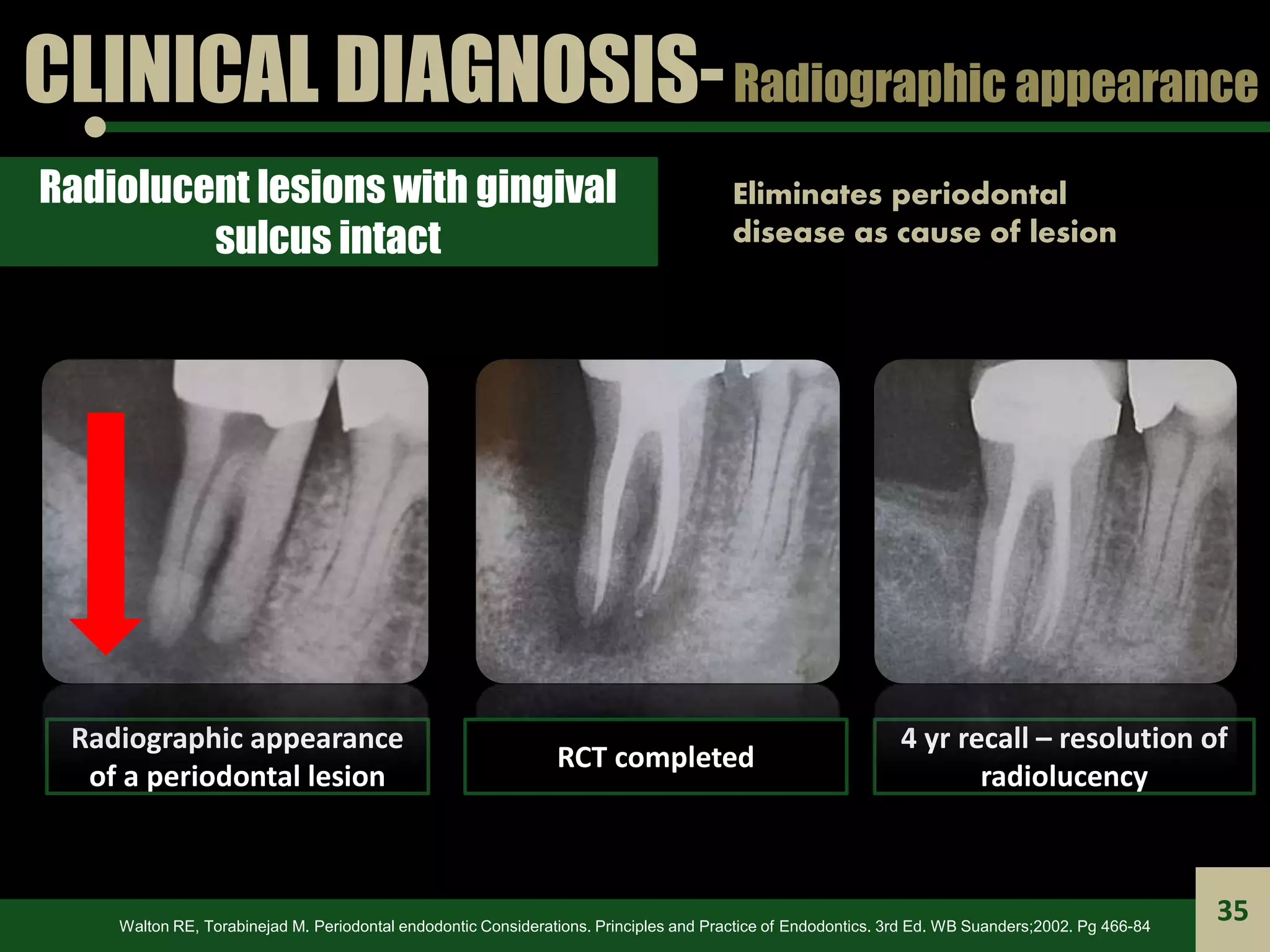 Endodontic Periodontal Relationship, ENDO PERIO LESION | PPTX