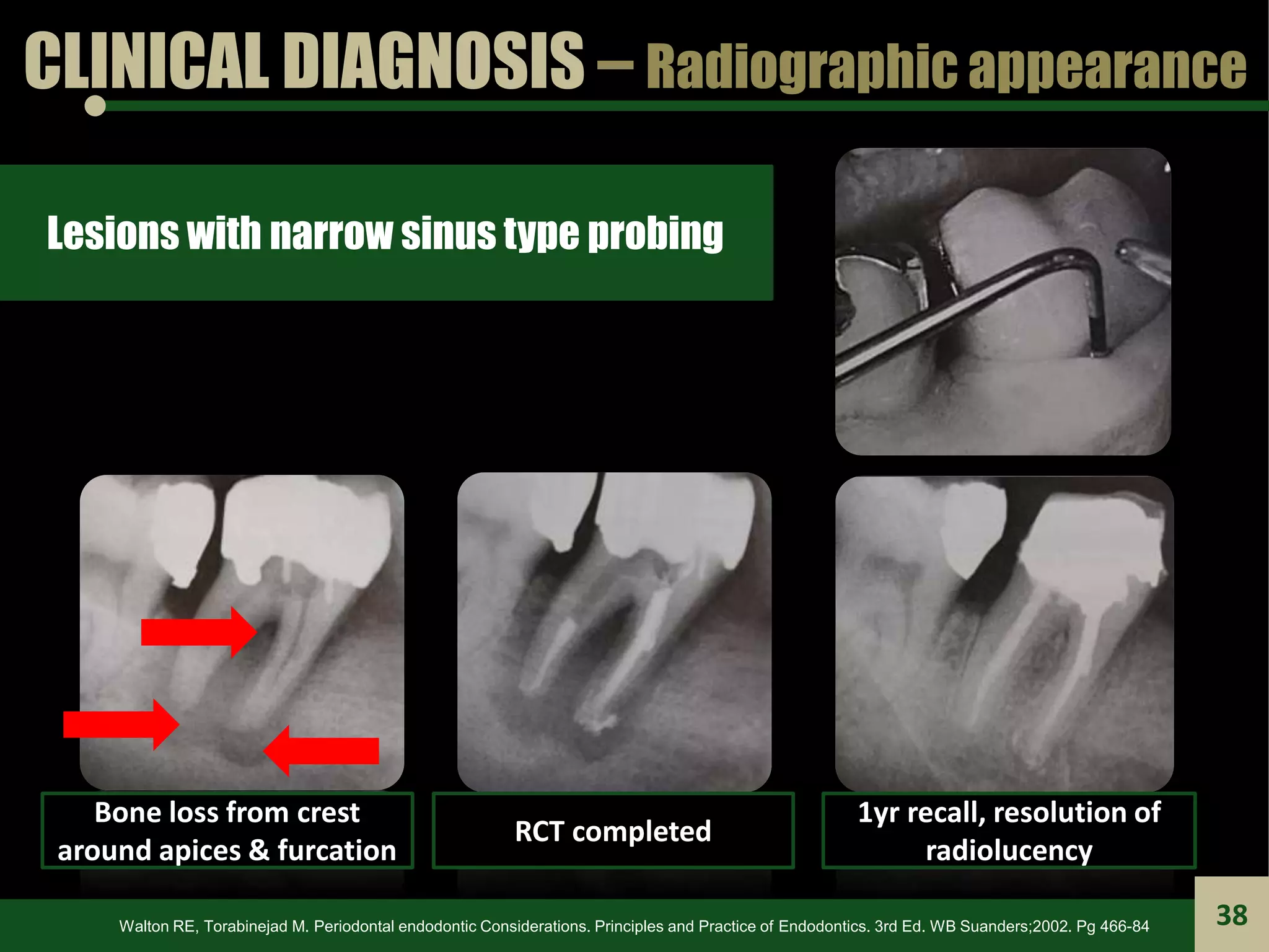 Endodontic Periodontal Relationship, ENDO PERIO LESION | PPTX