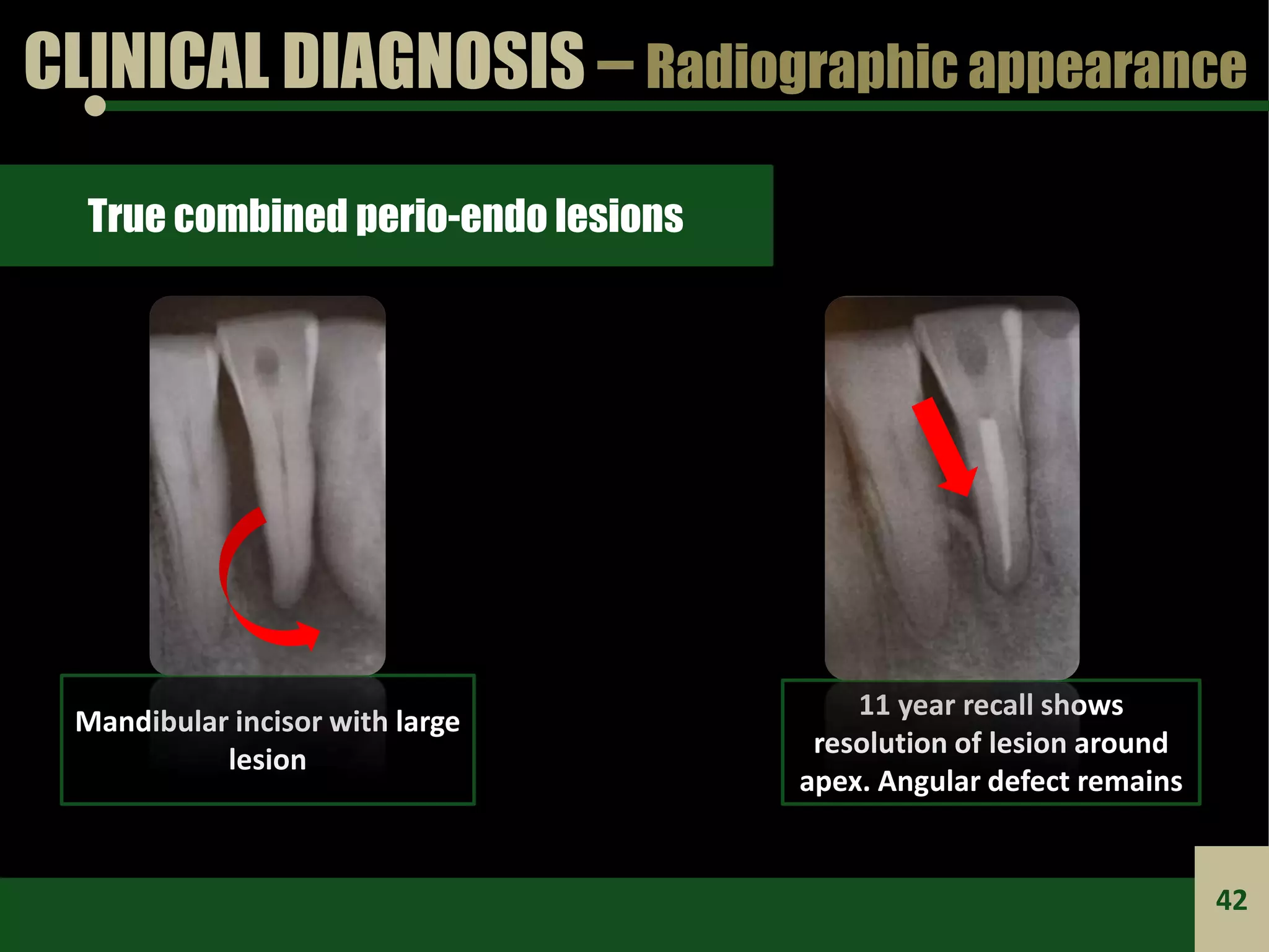 Endodontic Periodontal Relationship, ENDO PERIO LESION | PPTX