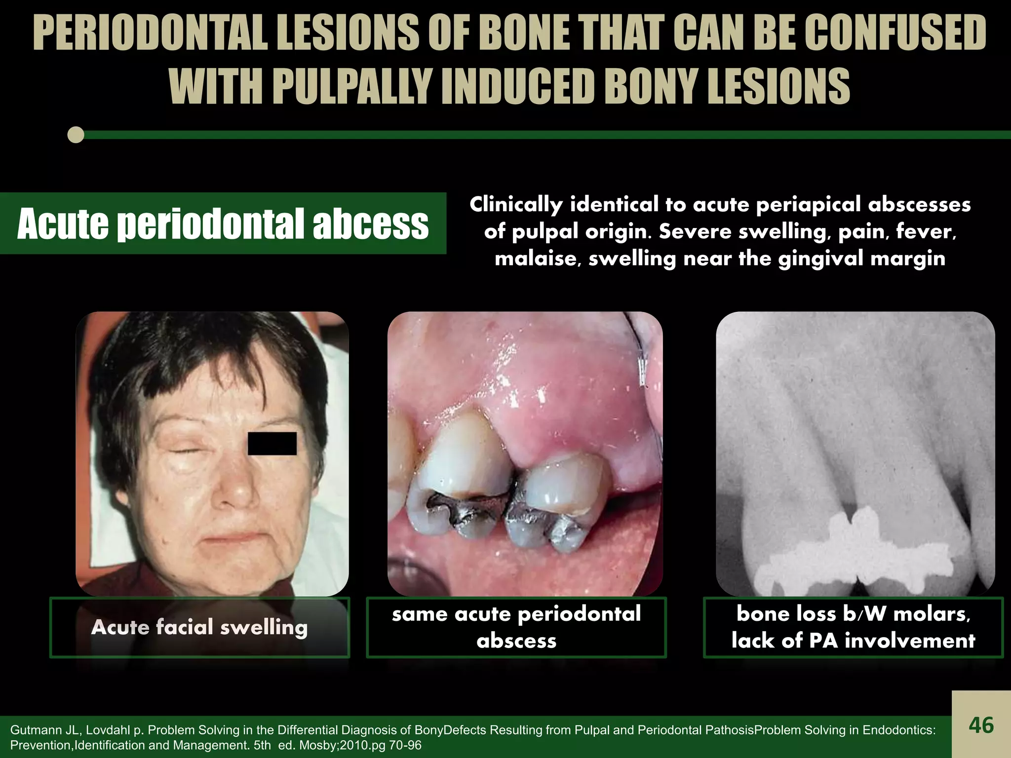 Endodontic Periodontal Relationship, ENDO PERIO LESION | PPTX