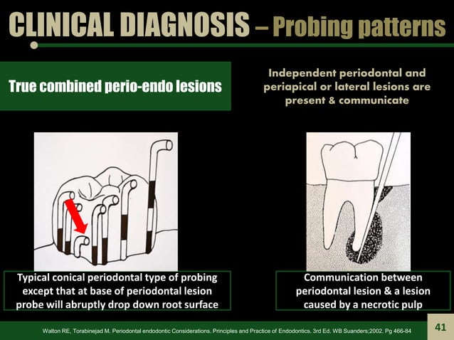 Endodontic Periodontal Relationship, ENDO PERIO LESION | PPTX | Dental ...