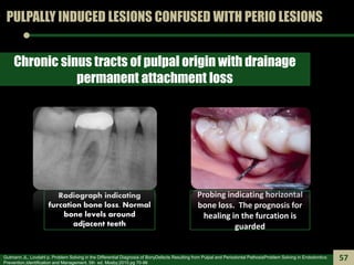 Endodontic Periodontal Relationship, ENDO PERIO LESION | PPTX