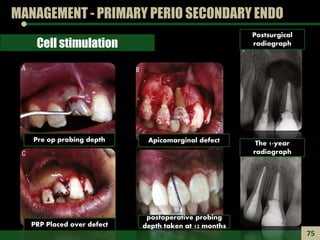 Endodontic Periodontal Relationship, ENDO PERIO LESION | PPTX
