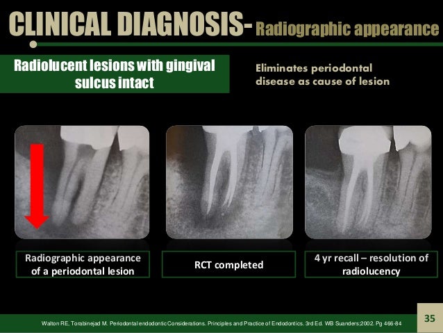 Endodontic Periodontal Relationship, ENDO PERIO LESION