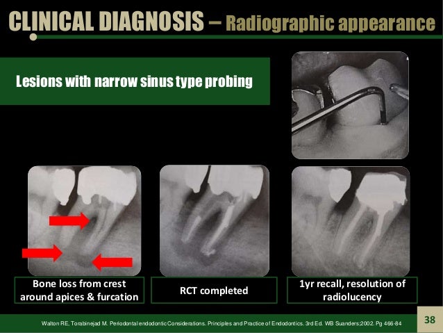 Endodontic Periodontal Relationship, ENDO PERIO LESION