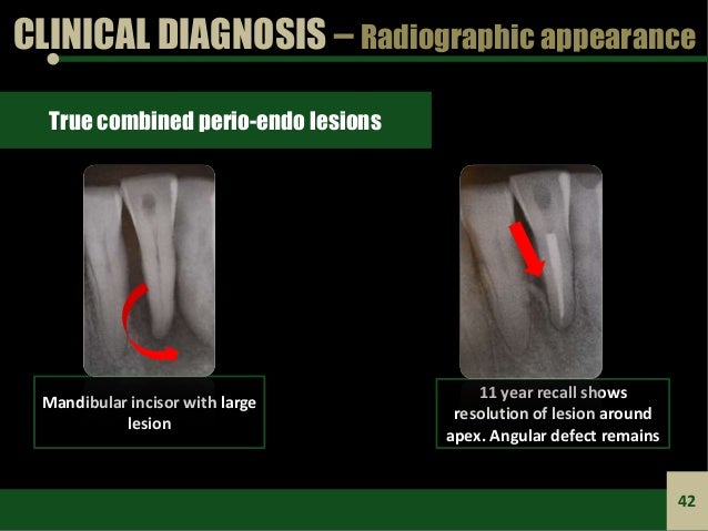 Endodontic Periodontal Relationship, ENDO PERIO LESION