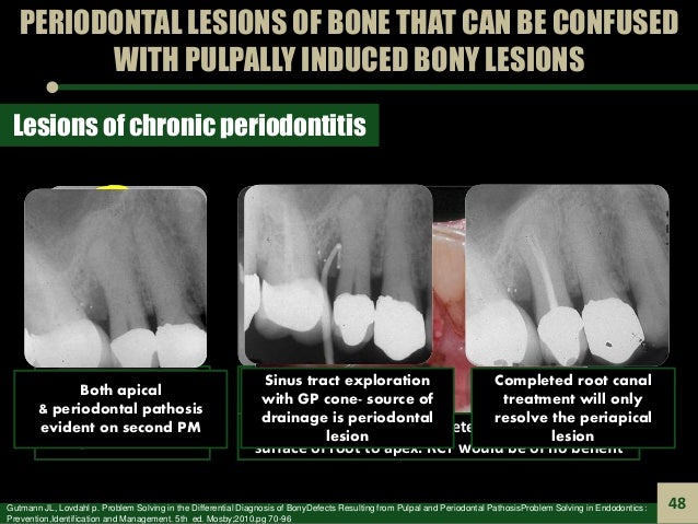 Endodontic Periodontal Relationship, ENDO PERIO LESION