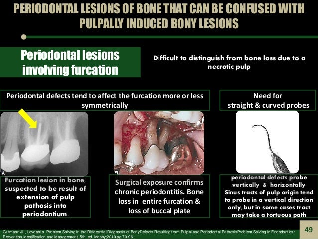 Endodontic Periodontal Relationship, ENDO PERIO LESION