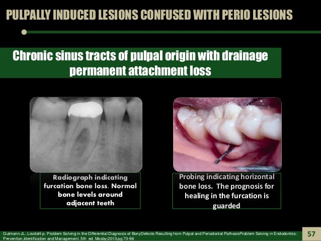 Endodontic Periodontal Relationship, ENDO PERIO LESION