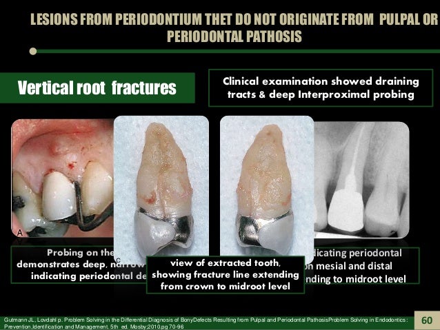 Endodontic Periodontal Relationship, ENDO PERIO LESION