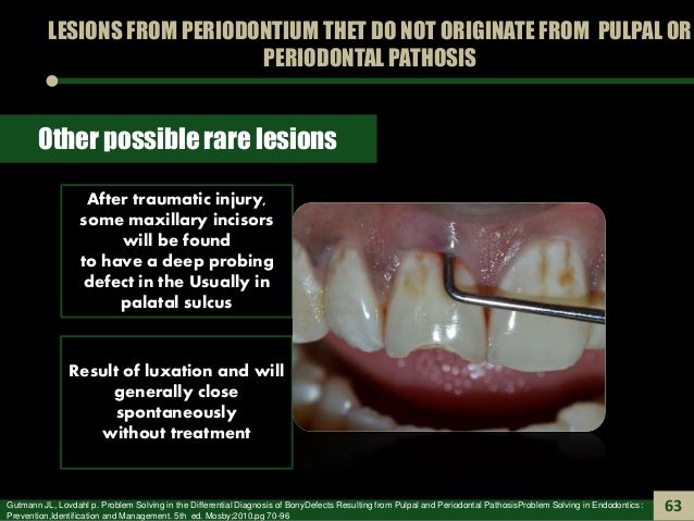 Endodontic Periodontal Relationship, ENDO PERIO LESION