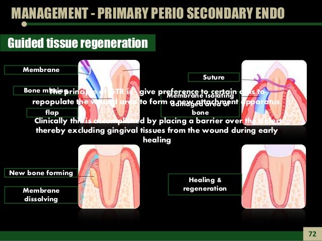 Endodontic Periodontal Relationship, ENDO PERIO LESION