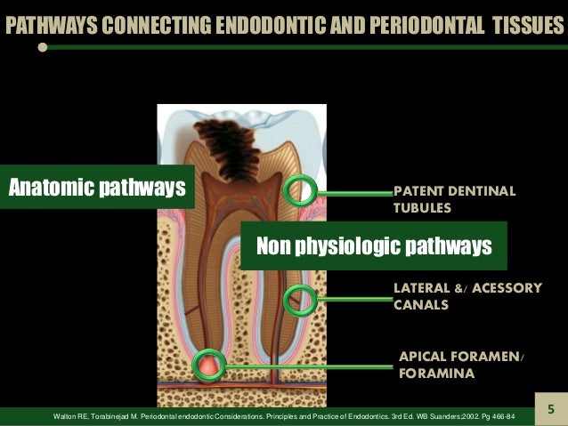 Endodontic Periodontal Relationship, ENDO PERIO LESION