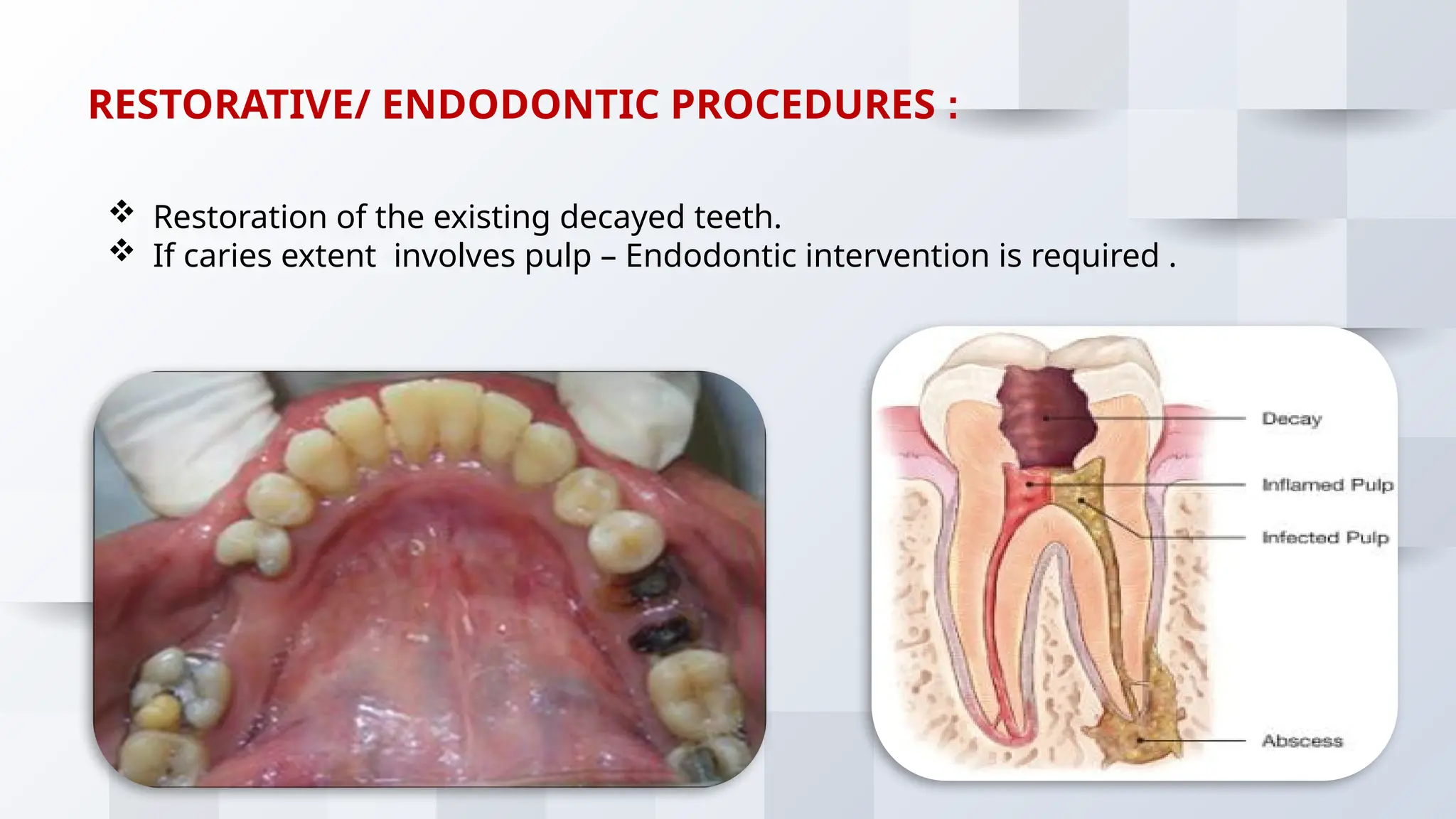 Seminar 5. Mouth preparation for RPD.pptx