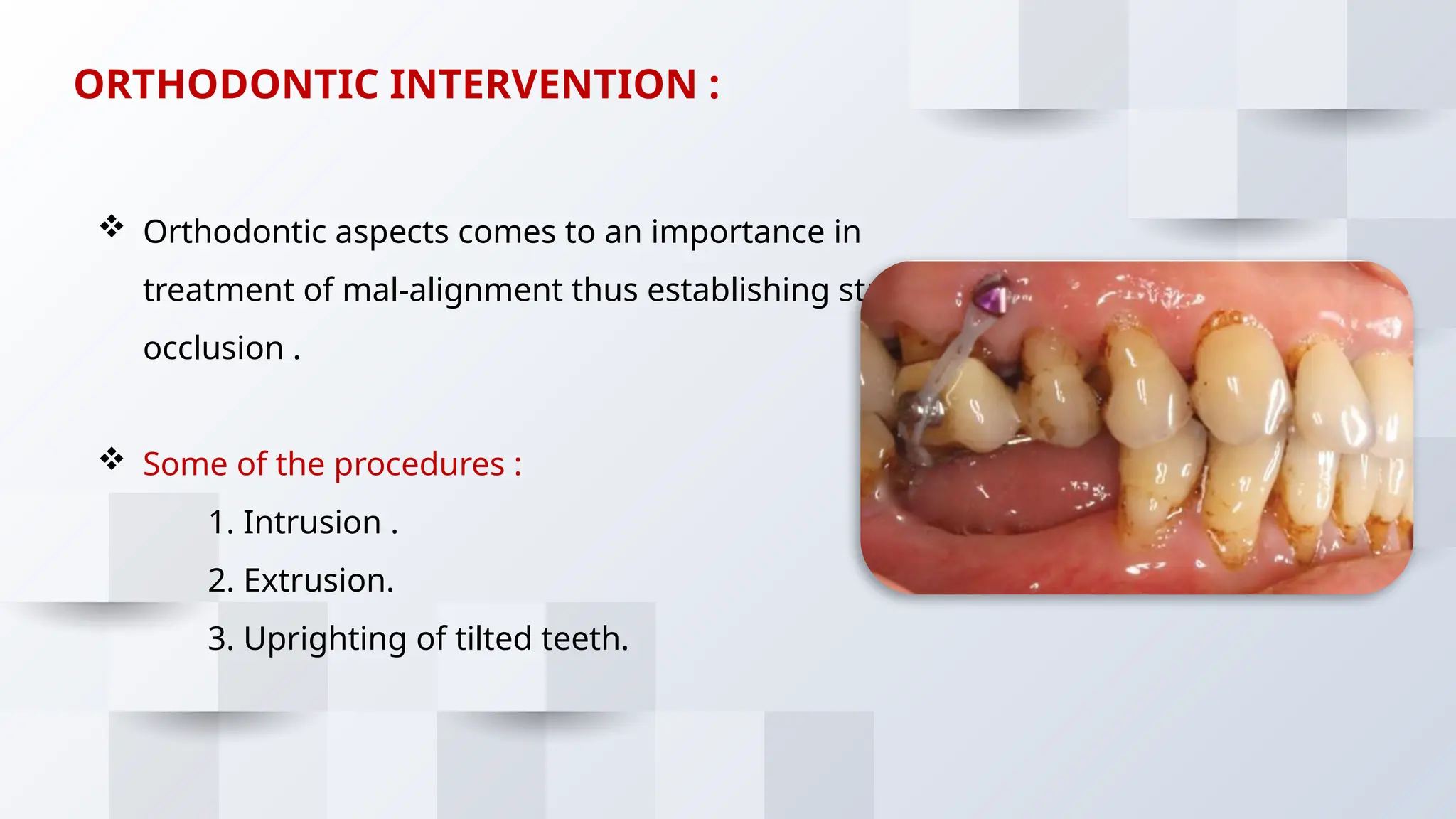 Seminar 5. Mouth preparation for RPD.pptx