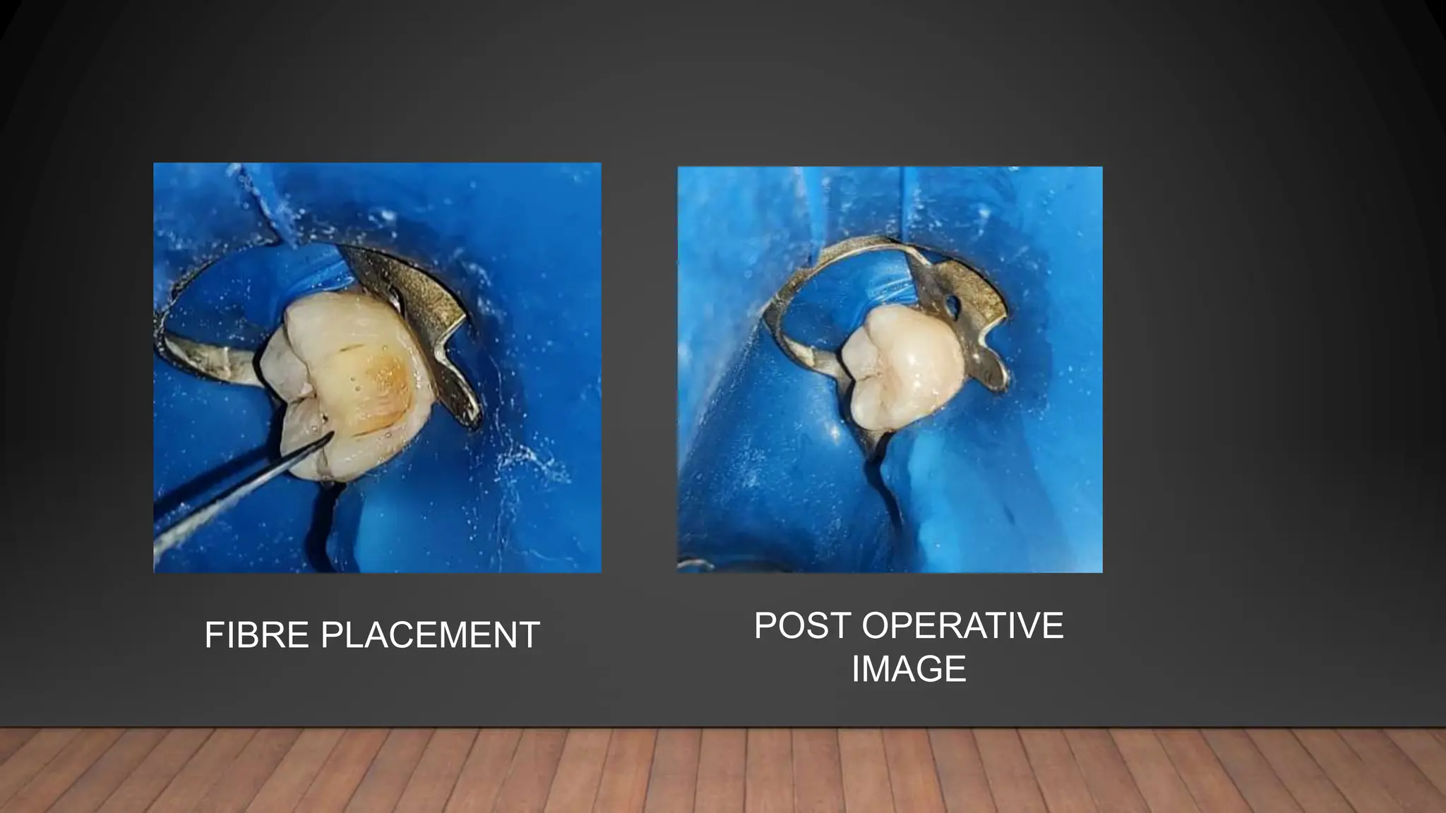 Minimally Invasive Dentistry In Conservative Dentistry Pptx 9710