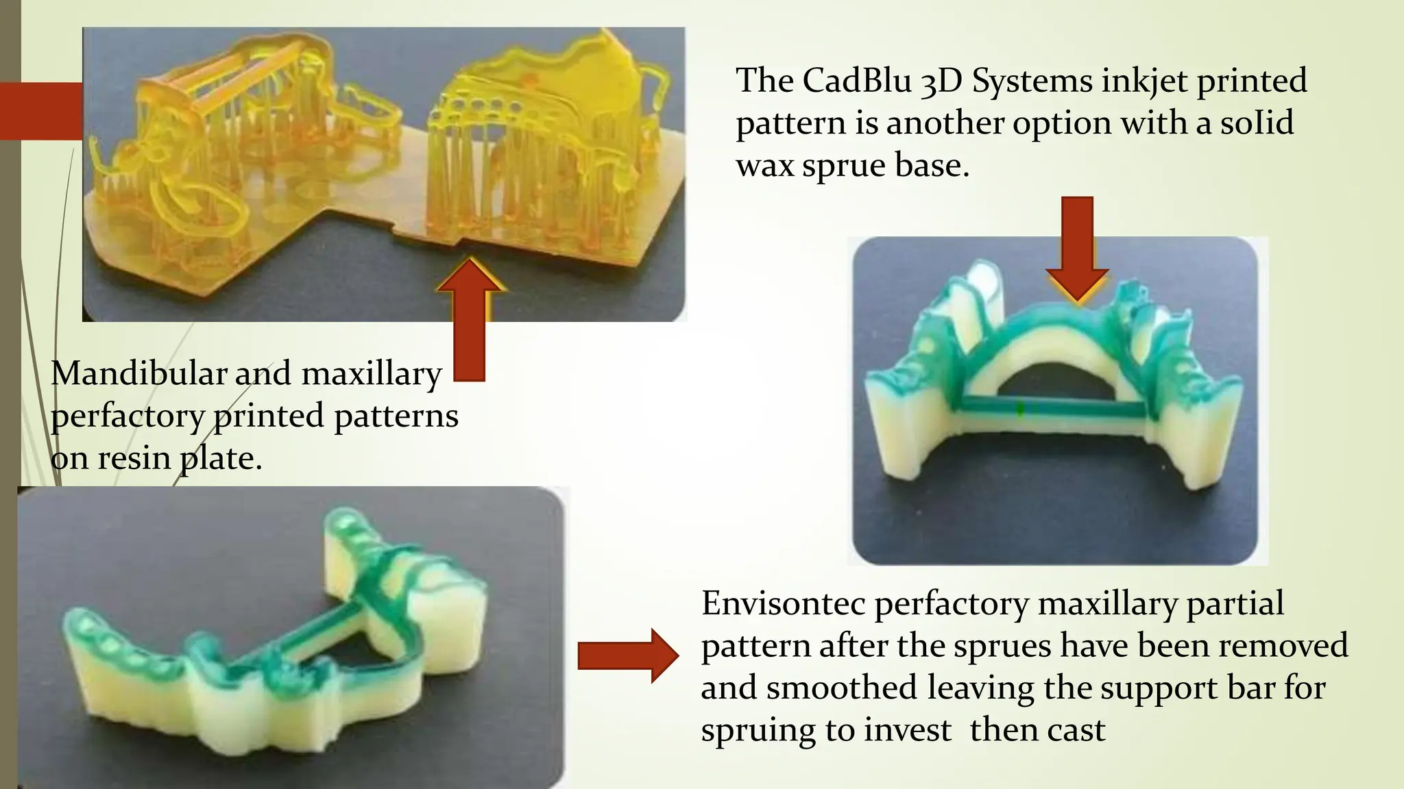 Recent advances in rpd and it's uses in prosthodontics | PPTX