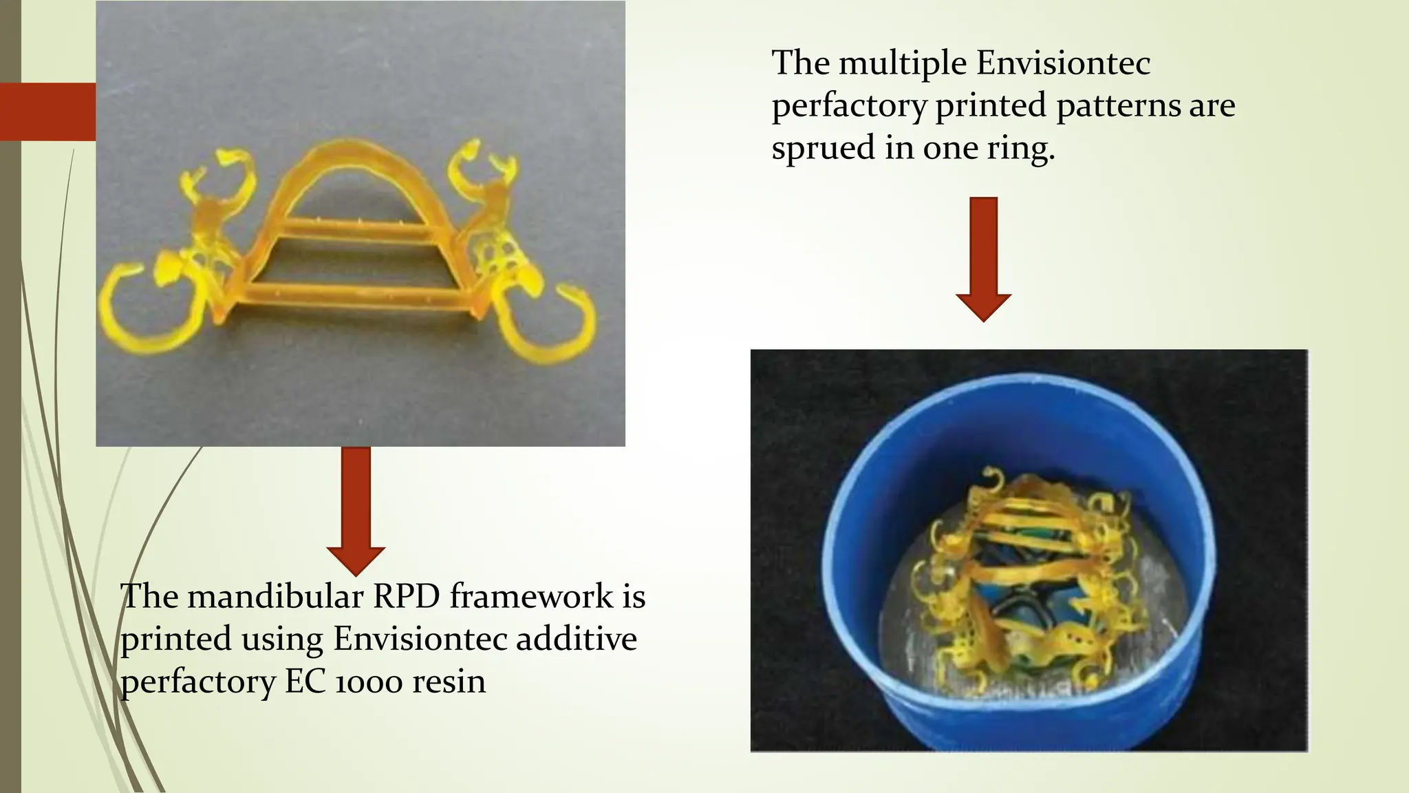 Recent advances in rpd and it's uses in prosthodontics | PPTX