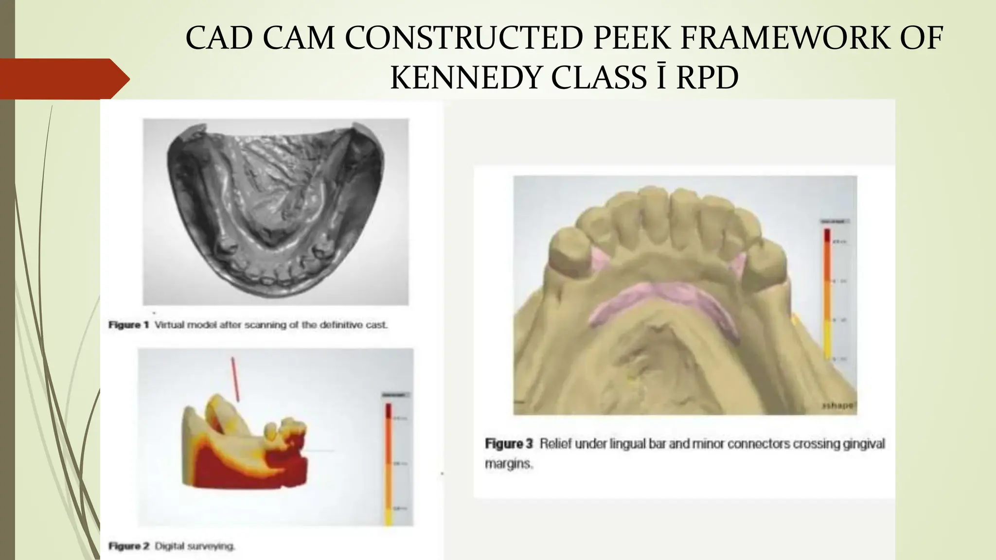 Recent advances in rpd and it's uses in prosthodontics | PPTX