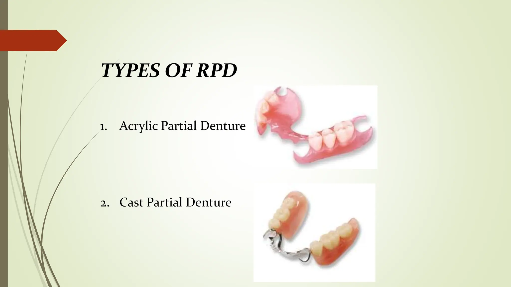 Recent advances in rpd and it's uses in prosthodontics | PPTX