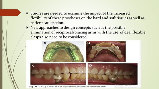 Recent advances in rpd and it's uses in prosthodontics | PPTX